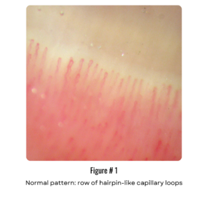 Capillaroscopy & Complementary Observations - Scleroderma BC