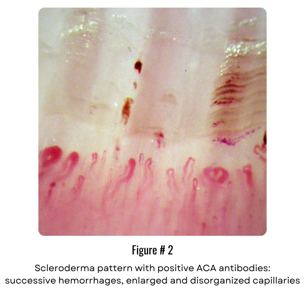 Capillaroscopy & Complementary Observations - Scleroderma BC