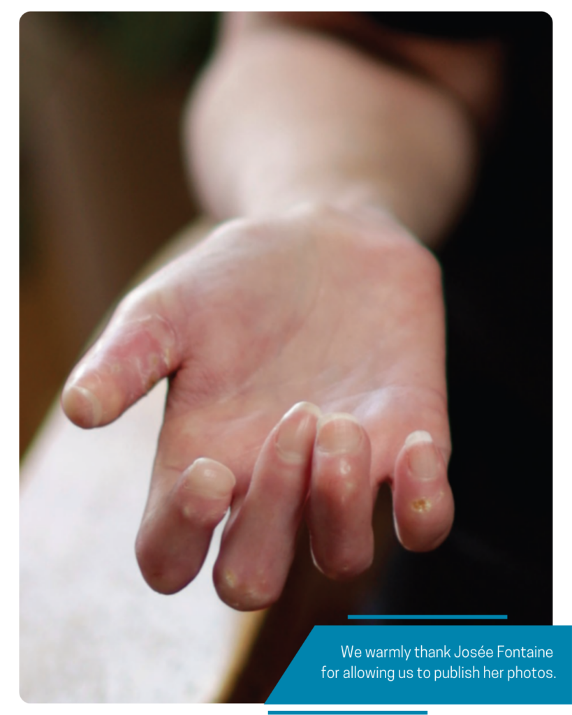 Calcinosis in Systemic Sclerosis - Scleroderma BC