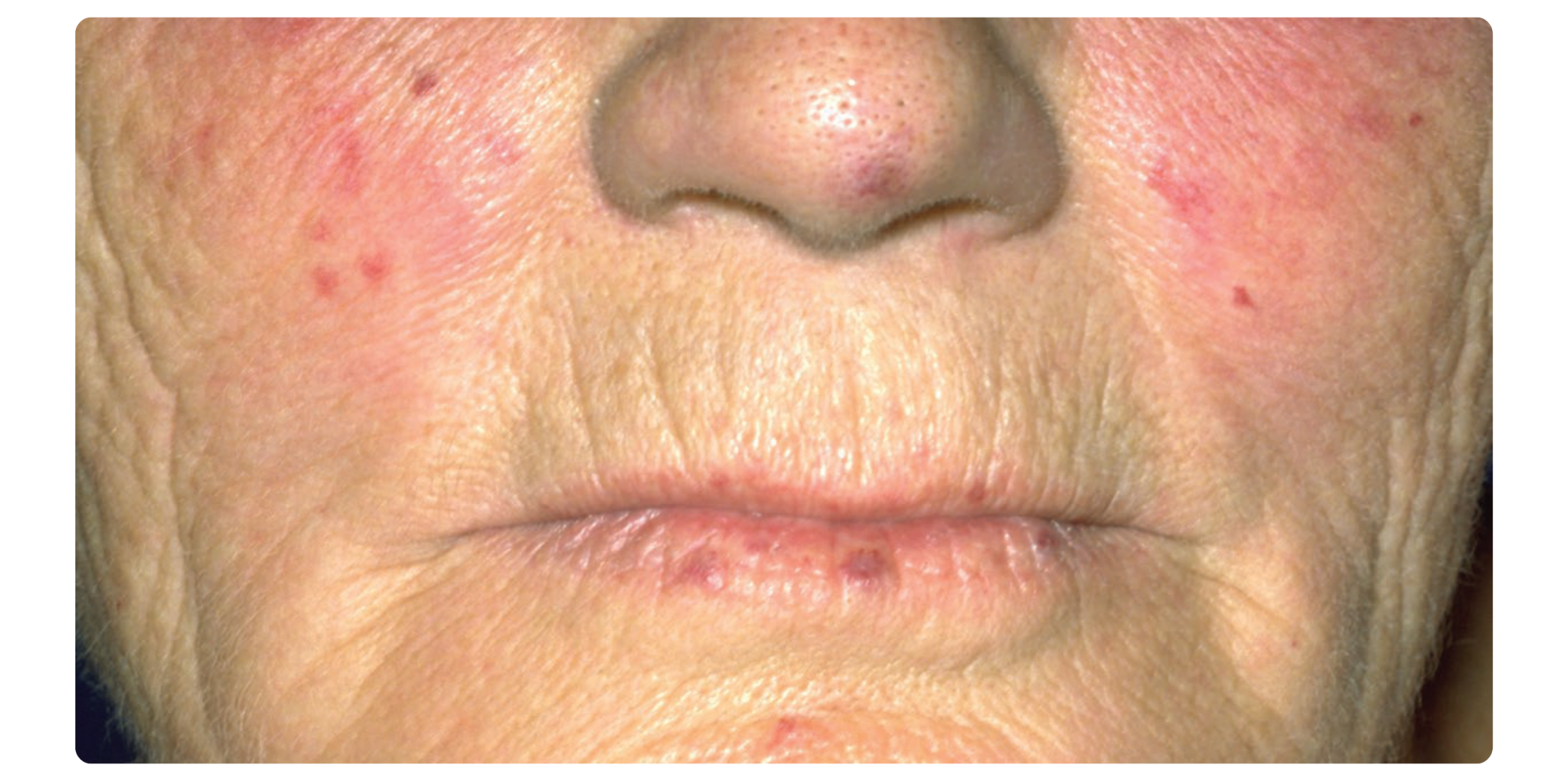 Dermatological Interventions for Facial Manifestations in Scleroderma ...